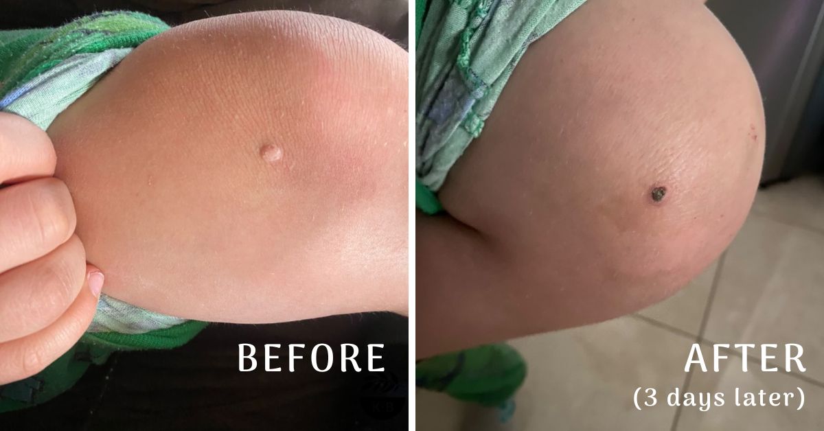 Apple cider vinegar - for warts and all | Krissy Ballinger - Naturally ...